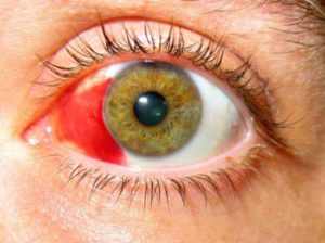 Broken Blood Vessels in Eyes: Causes and Treatment