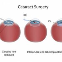 Aphakia: Definition, Causes and Treatment | EYExan.com