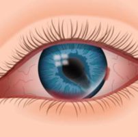 What Causes White Eye Discharge | EYExan.com