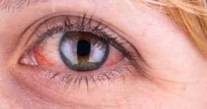Red Eyes and Blurry Vision: Causes and Remedies | EYExan.com