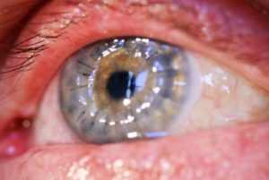 Corneal Transplantation Surgery: What You Should Know | EYExan.com