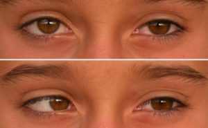 Lazy Eye Syndrome (Amblyopia): Causes and Treatment