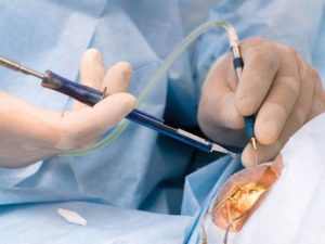 Pain After Cataract Surgery: Prevention and Follow-Up Steps | EYExan.com