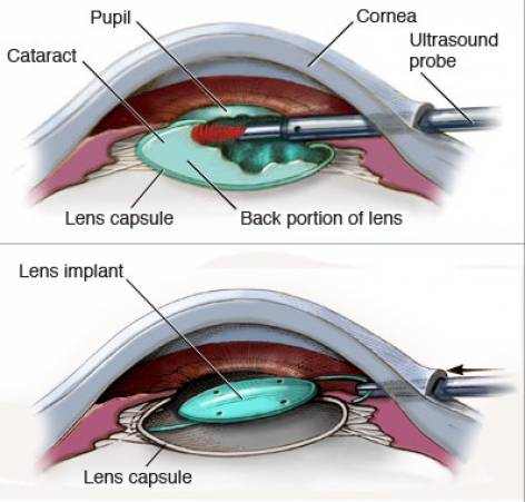 Cataract Surgery - Facts You Should Know | EYExan.com