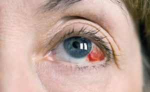 Eye Strokes: CRAO, BRVO And Other Retinal Artery And Vein Occlusions ...