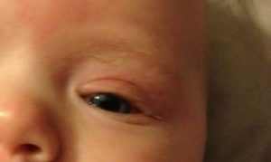 Pinkeye in Babies: Causes, Symptoms, Treatment | EYExan.com