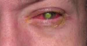 What Happens if You Leave Contacts in Too Long or Sleeping in Contact ...