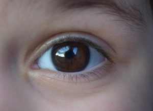 Goopy Eyes in Toddler: Causes and Treatment | EYExan.com