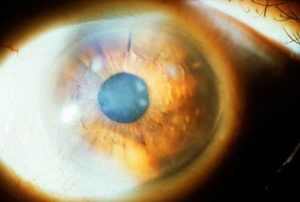 Fuchs' Corneal Dystrophy: What You Should Know | EYExan.com