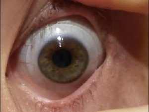 Scleral Contact Lenses: What You Should Know | EYExan.com