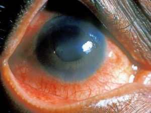 Uveitis, Eye Inflammation: Causes and Treatment – EYExan.com