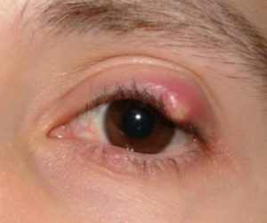 Chalazion: Causes and Treatment | EYExan.com