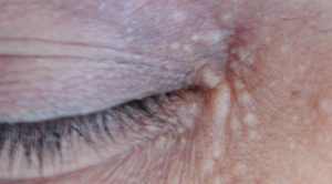 How to Remove Warts From Eyelids Fast | EYExan.com