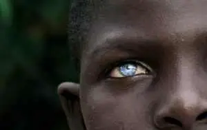 Ocular Albinism: Causes, Symptoms, Treatment | EYExan.com