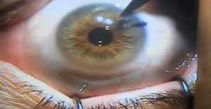 YAG Laser Eye Surgery after Cataract Surgery – EYExan.com