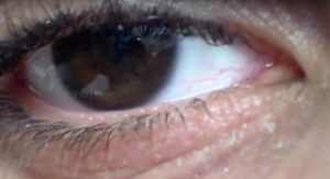 What Does It Mean When Your Eye Jumps – EYExan.com