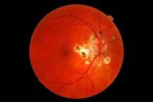 Ocular Histoplasmosis Syndrome: Causes, Signs, Treatment & FAQ