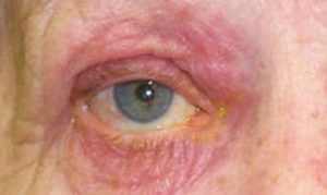 Natural Treatment of Ocular Rosacea | Eyexan.com