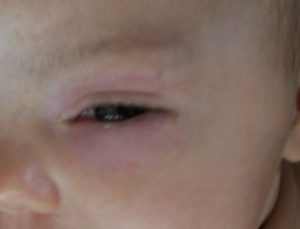 Blocked Tear Ducts: Causes, Signs and Treatment