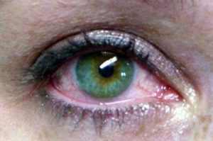 Causes of Watery Eyes and How to Stop It