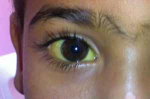 How to Get Rid of Yellow Eyes Fast