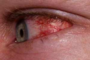 Top 7 Home Remedies for Eye Infection | EYExan.com