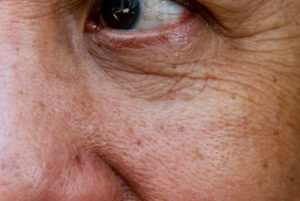 Lines Under Eyes and How to Remove Them