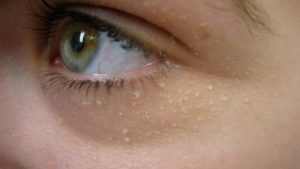 Milia Under Eye: Causes, Treatment and Prevention