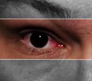 Why Are My Eyes Always Red? – EYExan.com