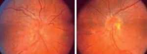 Leber's Hereditary Optic Neuropathy: What You Should Know
