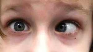 Difference Between Amblyopia and Strabismus – EYExan.com