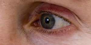 Excessive Eye Boogers: Causes, Types and Treatment – EYExan.com