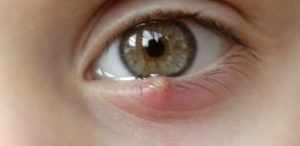 Multiple Styes in Eye: Causes, Treatment, Complications – EYExan.com