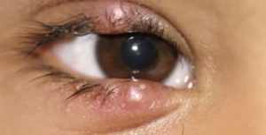 Multiple Styes in Eye: Causes, Treatment, Complications – EYExan.com